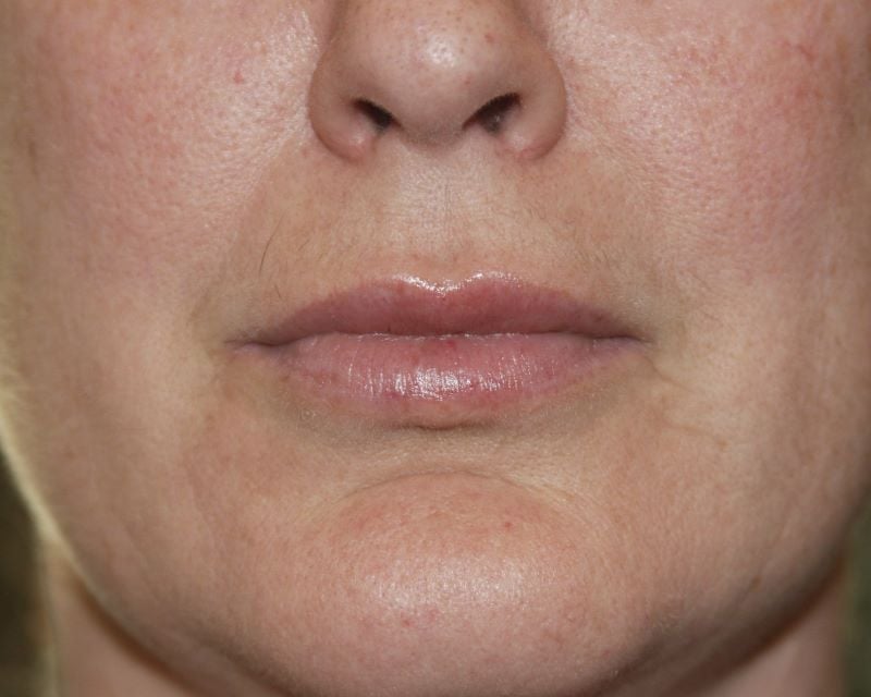 Permanent Lip Filler in Raleigh NC | Long Lasting Lip Filler Raleigh