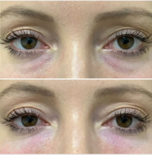 Rejuvenate Your Under-Eye Area Naturally with PRP Treatment
